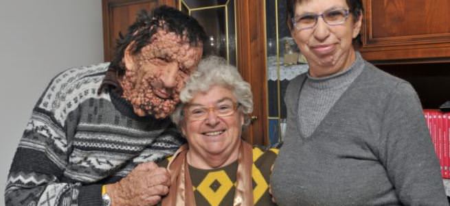 'Fil Adam' ilk kez konuştu - Aktüel Haberleri